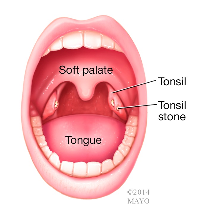 What to know about tonsil stones - Mayo Clinic Health System